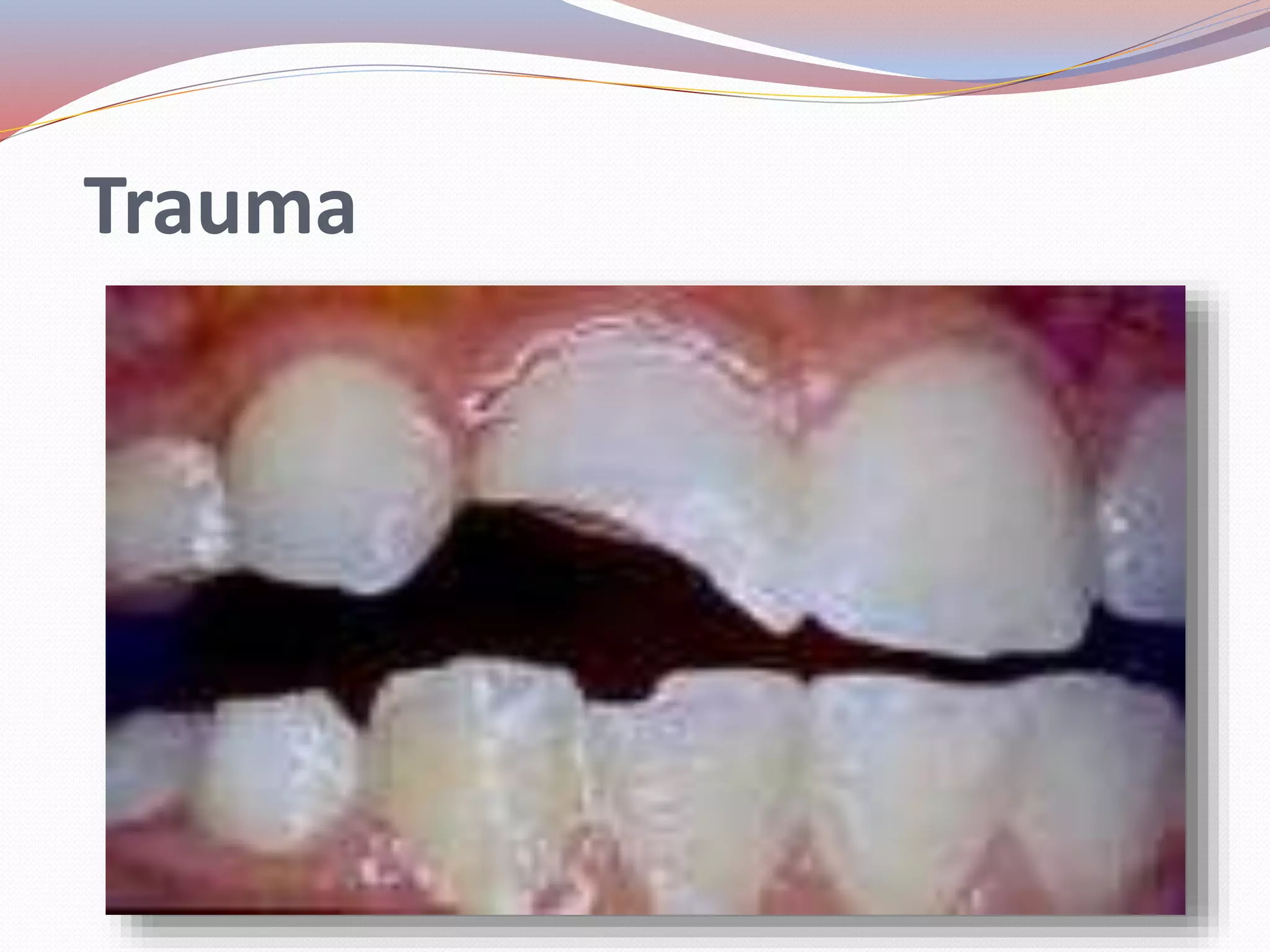 Parallel angle technique vs bisecting angle technique. | PPTX