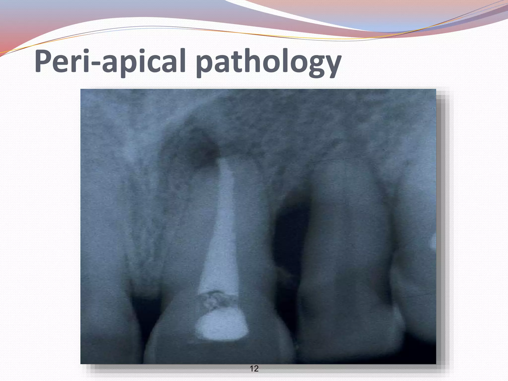 Parallel Angle Technique Vs Bisecting Angle Technique Pptx Dental Health Diseases And
