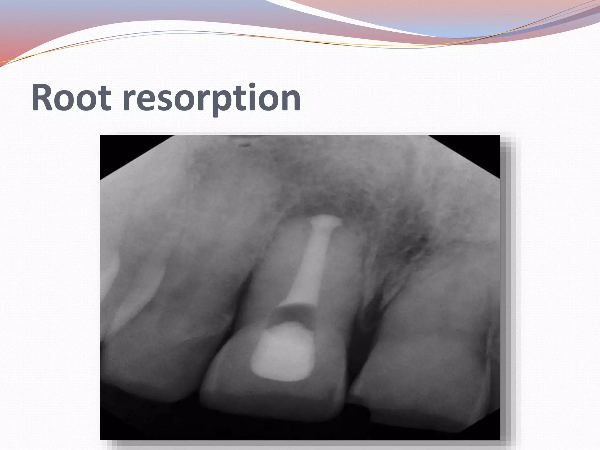 Parallel angle technique vs bisecting angle technique. | PPTX