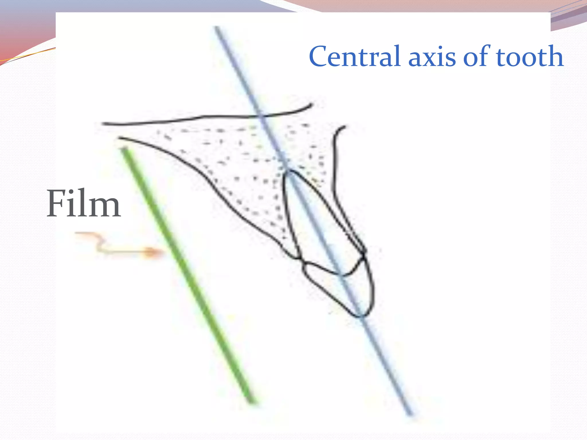Parallel angle technique vs bisecting angle technique. | PPTX