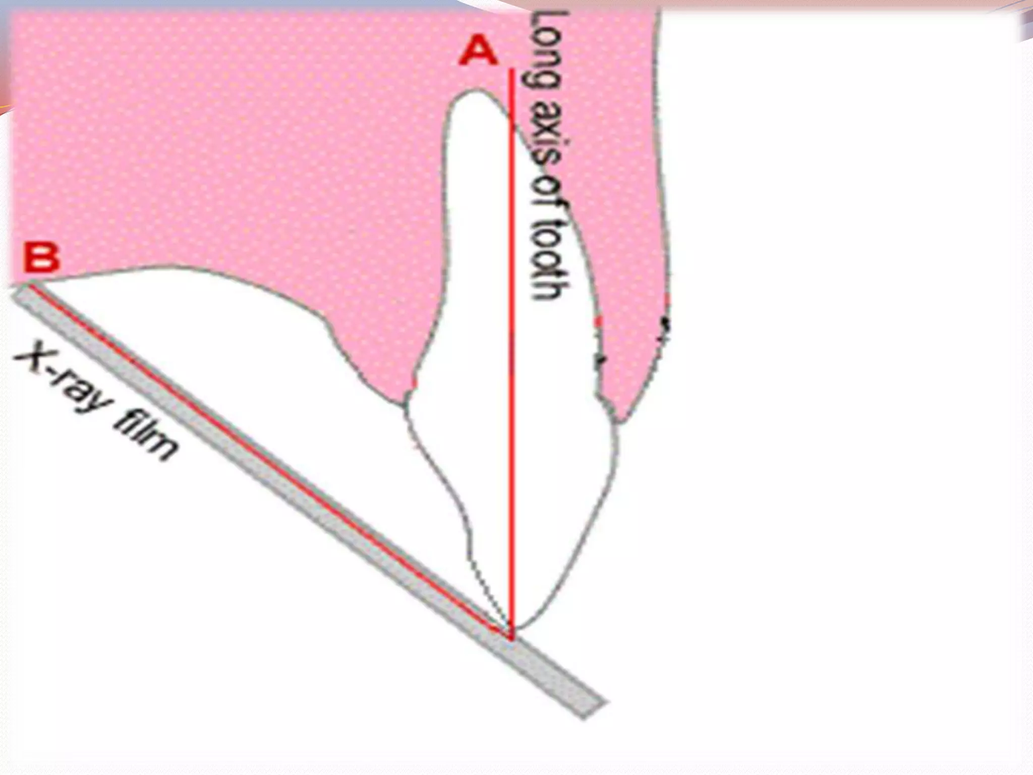 Parallel angle technique vs bisecting angle technique. | PPTX