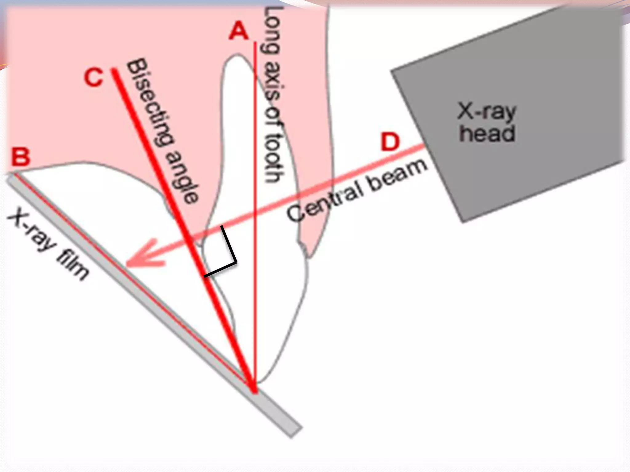 Parallel angle technique vs bisecting angle technique. | PPTX