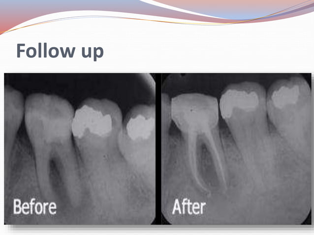 Parallel angle technique vs bisecting angle technique. | PPTX | Dental ...