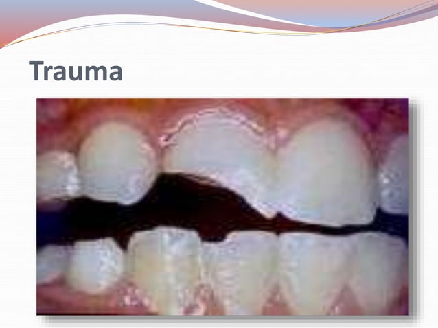 Parallel angle technique vs bisecting angle technique. | PPTX | Dental ...