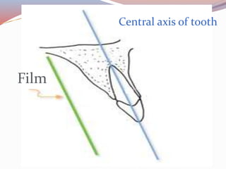 Parallel angle technique vs bisecting angle technique. | PPTX