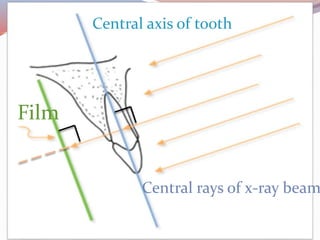 Parallel angle technique vs bisecting angle technique. | PPTX