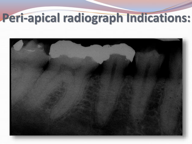Parallel angle technique vs bisecting angle technique. | PPTX | Dental ...