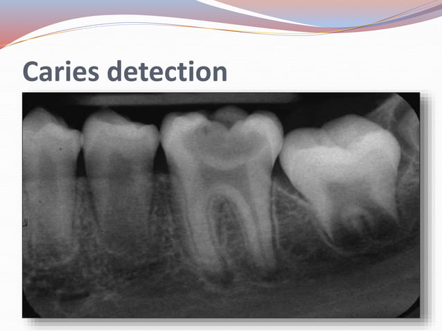 Parallel angle technique vs bisecting angle technique. | PPTX | Dental ...