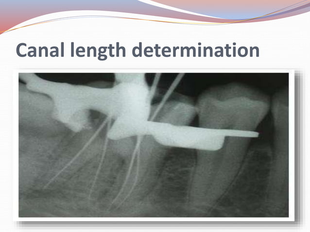 Parallel angle technique vs bisecting angle technique. | PPTX | Dental ...