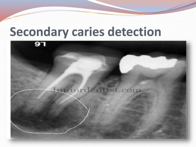 Parallel angle technique vs bisecting angle technique. | PPTX | Dental ...