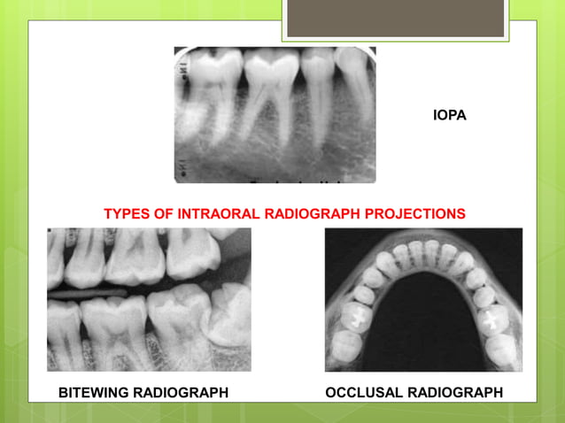 Paralleling and bisecting radiographic techniques | PPTX | Dental ...