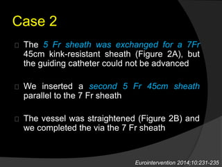 Parallel sheath technique | PPTX