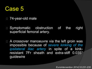 Parallel sheath technique | PPTX