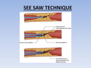 Parallel wire Technique in CTO PCI | PPTX