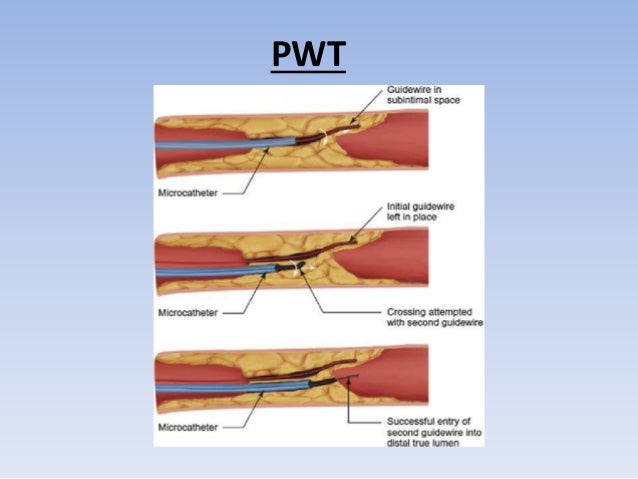 Parallel wire Technique in CTO PCI
