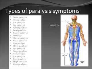 Paralysis | PPT
