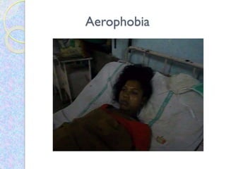 Paralytic RABIES | PPT