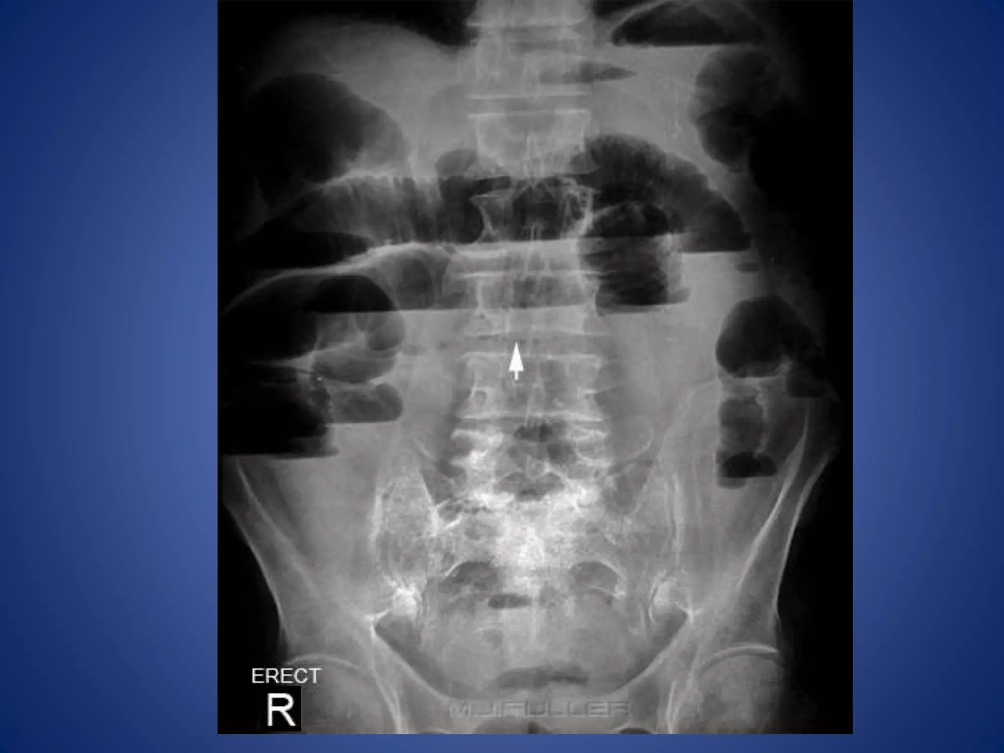 Paralytic ileus | PPTX