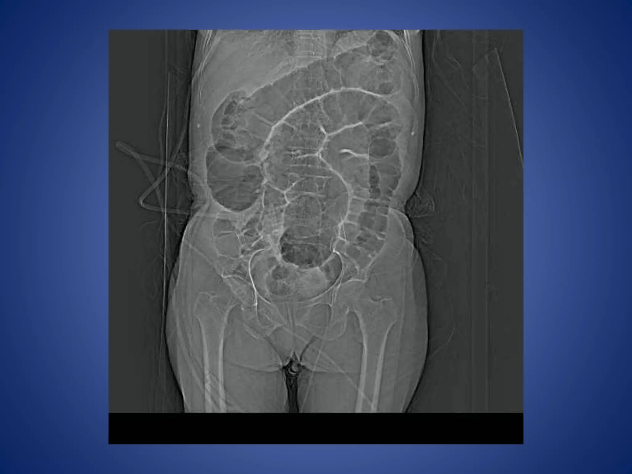 Paralytic ileus | PPTX