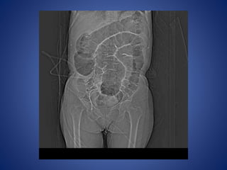 Paralytic ileus | PPTX