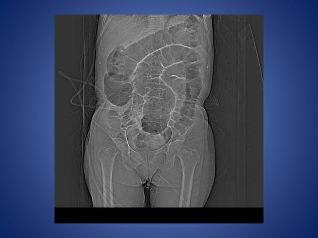 Paralytic ileus | PPTX | Digestive Disorders | Diseases and Conditions