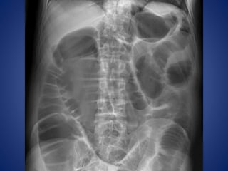 Paralytic ileus | PPT
