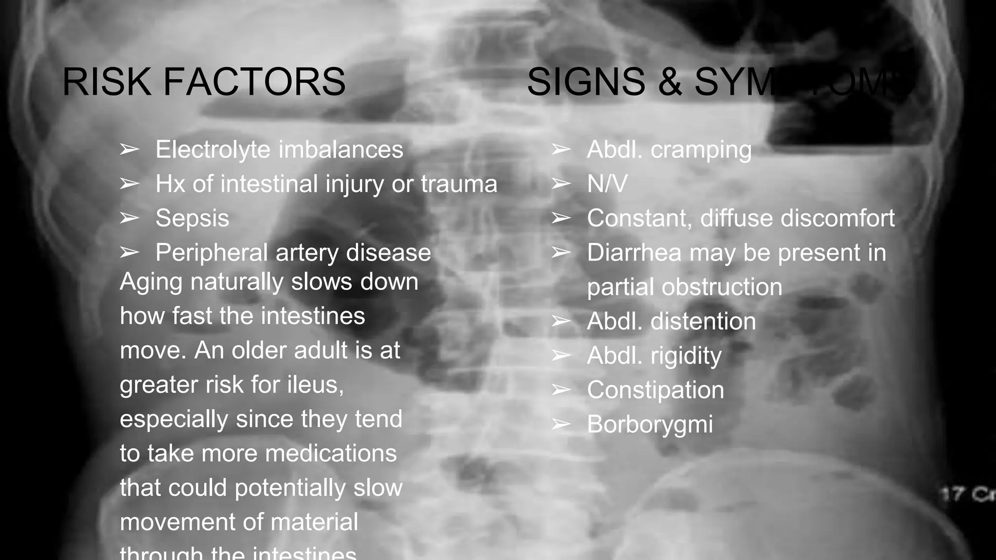 Paralytic ileus | PPTX