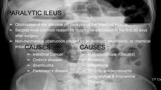 Paralytic ileus | PPTX