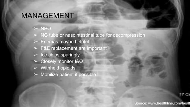 Paralytic ileus | PPTX