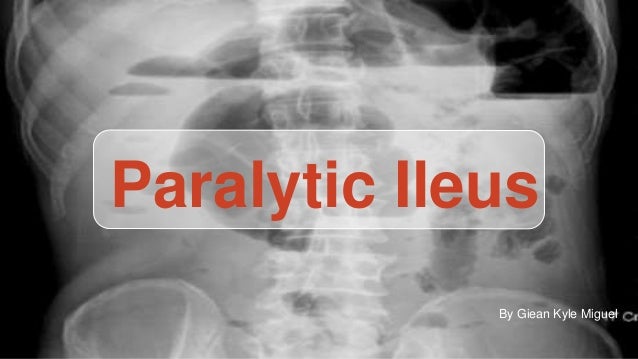 Paralytic ileus