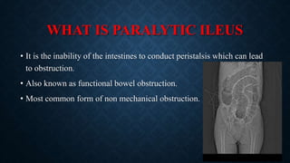 Paralytic Ileus