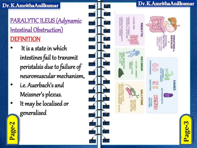 Paralytic ileus (adynamic intestinal obstruction) | PPTX