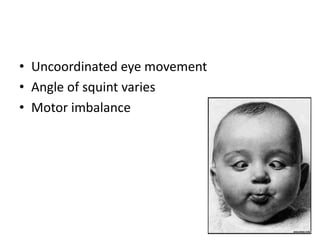 Paralytic squint | PPTX