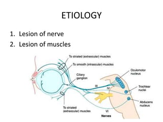 Paralytic squint | PPTX