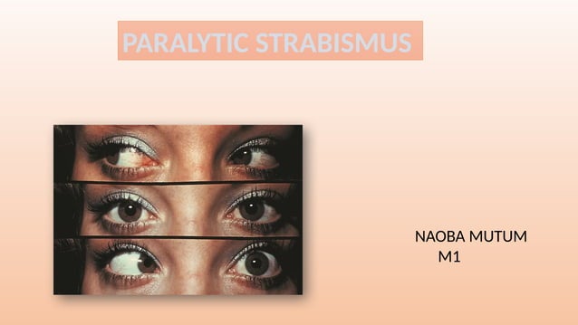 Paralytic Strabismus presentation slideshare.pptx | Brain and Nervous System Disorders ...
