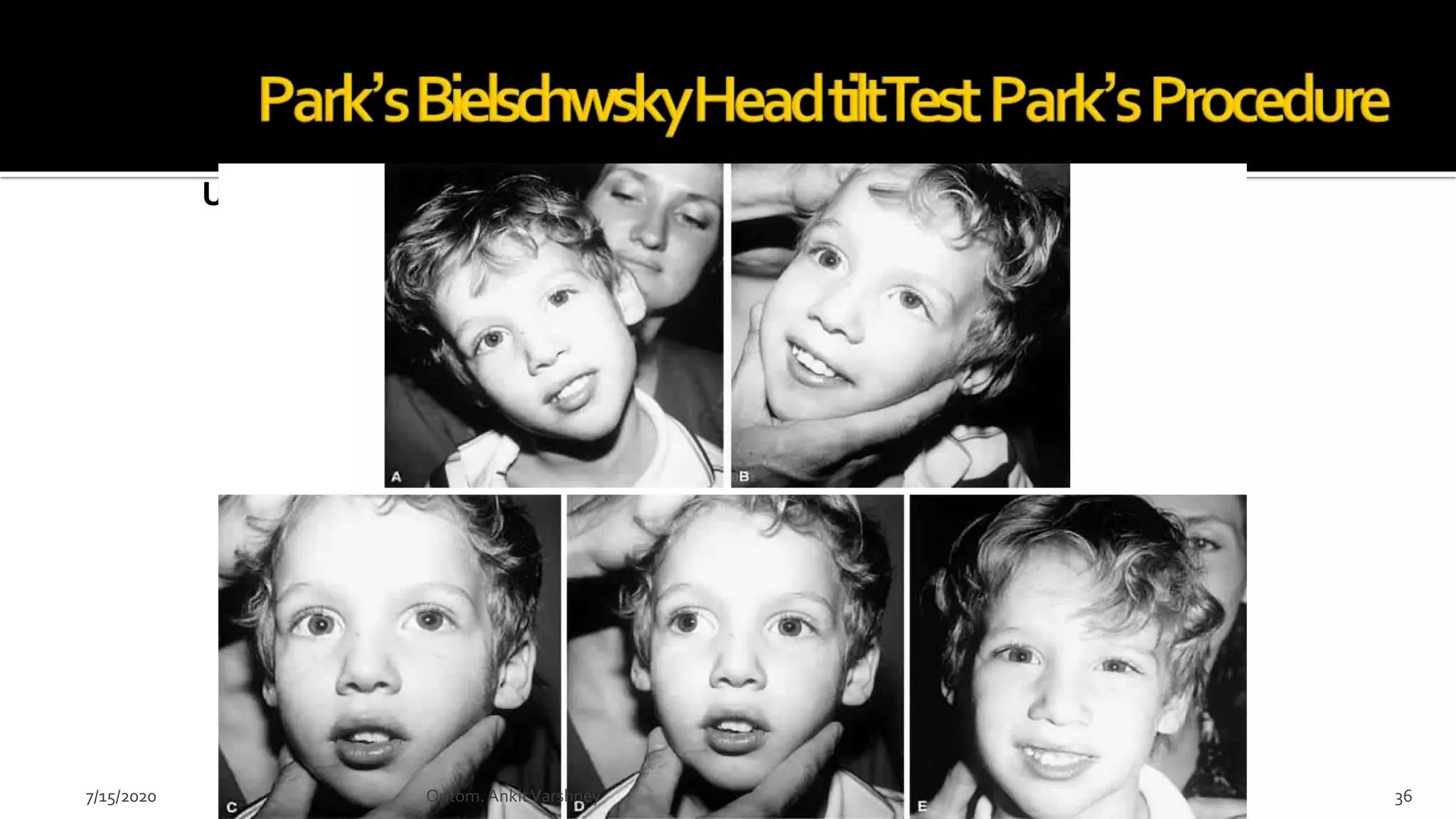 Paralytic strabismus by Ankit Varshney | PPTX