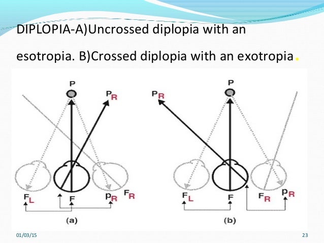 Paralytic strabismus, features and investigations of paretic strabism…