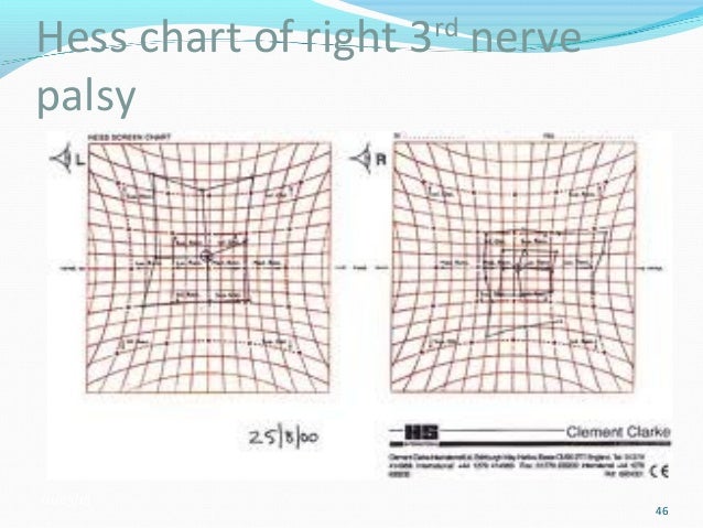 Paralytic strabismus, features and investigations of paretic strabism…