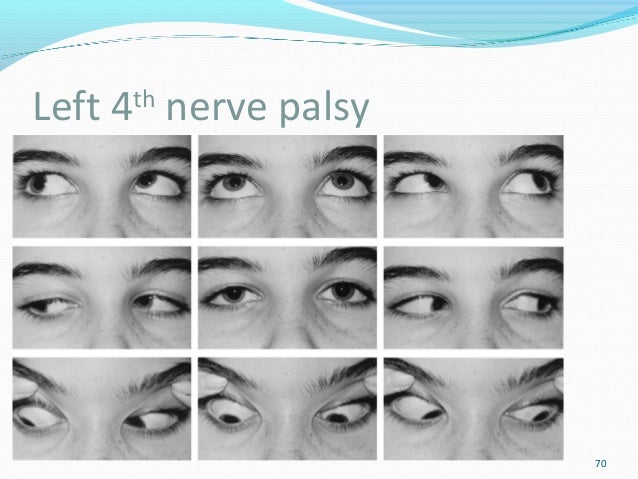 Paralytic strabismus, features and investigations of paretic strabism…