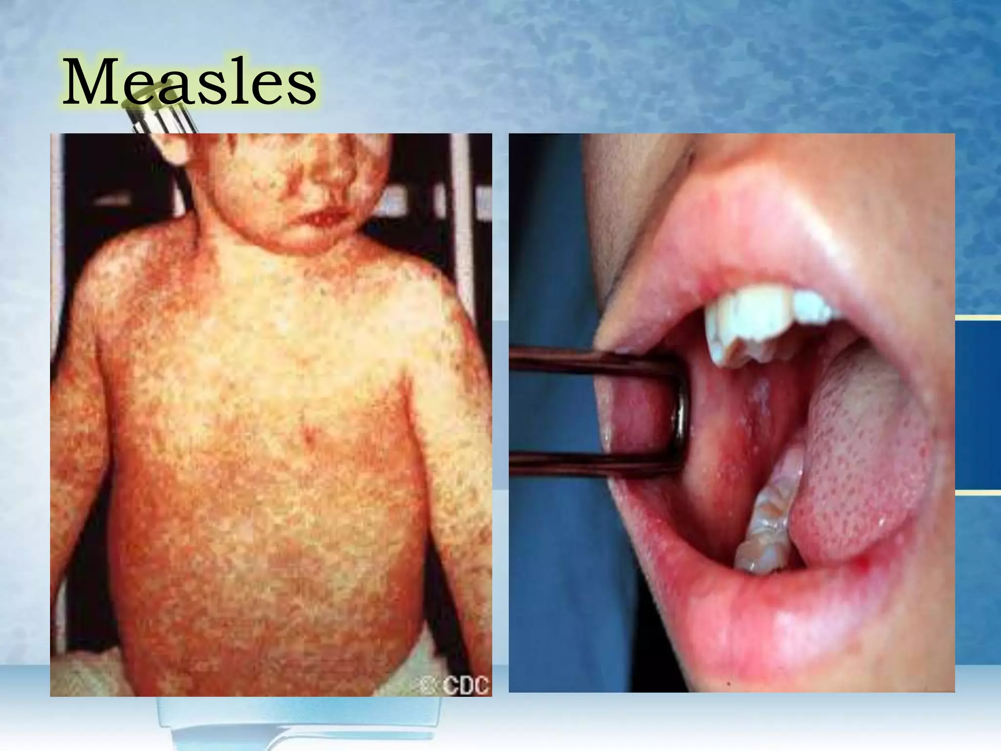 Paramyxovirus | PPTX | Infectious Diseases | Diseases and Conditions