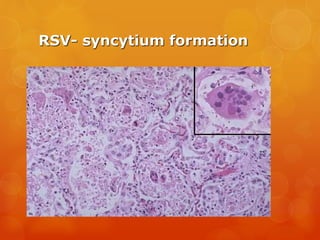 Paramyxo virus Classification Symptoms and Lab diagnosis | PPTX