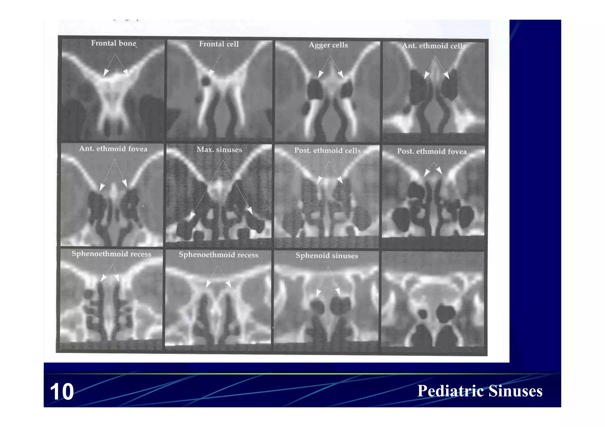 CT anatomy of the paranasal sinuses | PDF