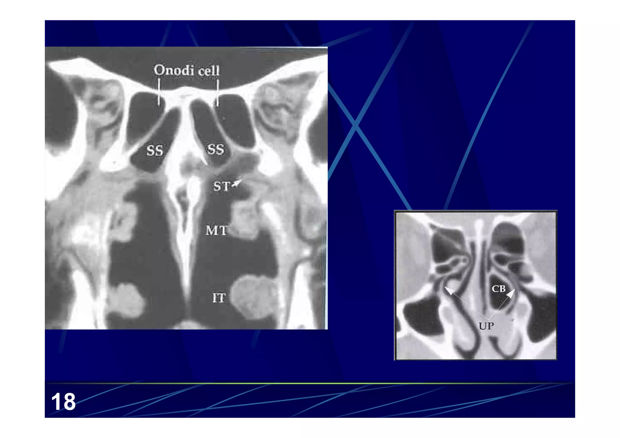 CT anatomy of the paranasal sinuses | PDF