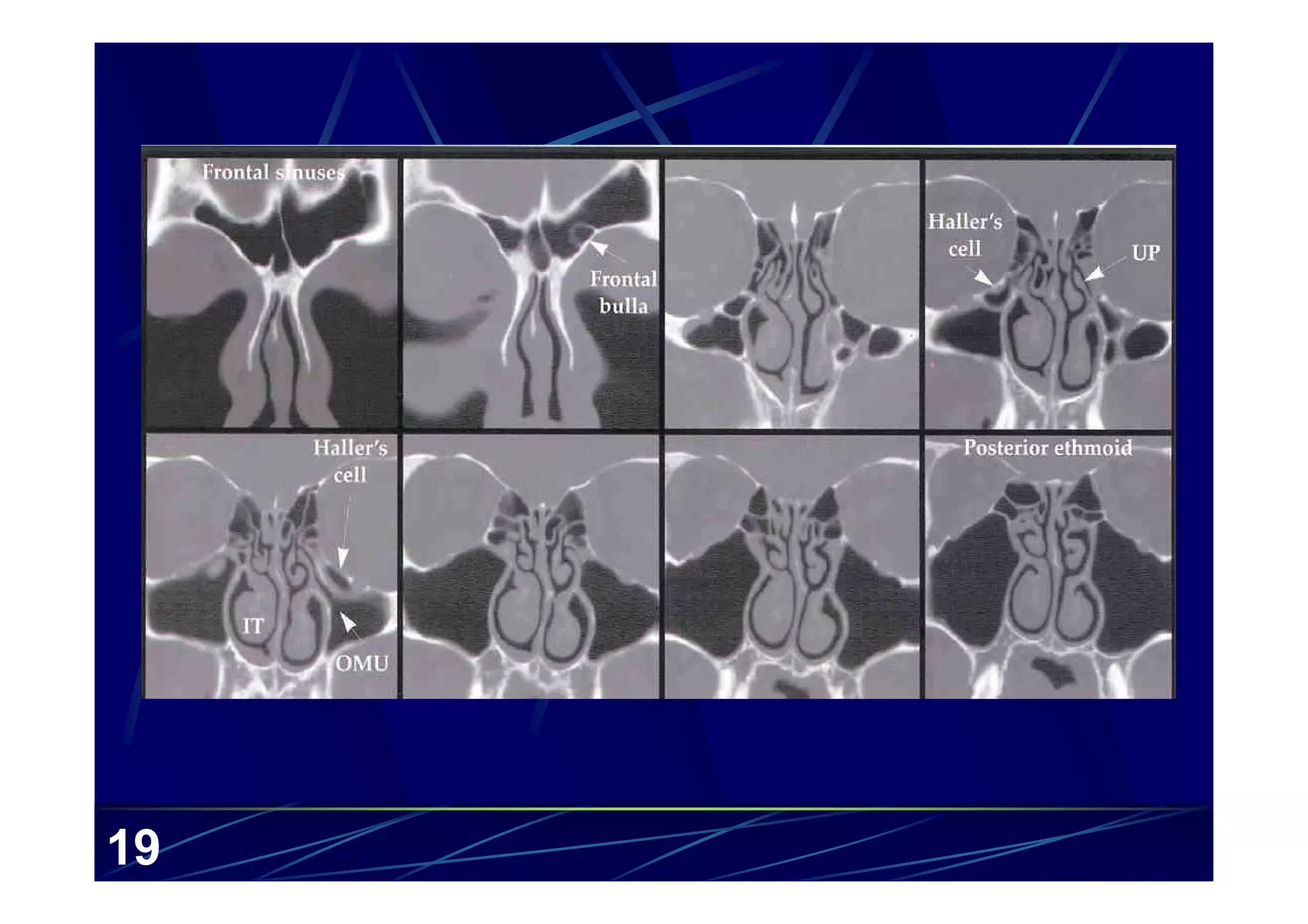 CT anatomy of the paranasal sinuses | PDF