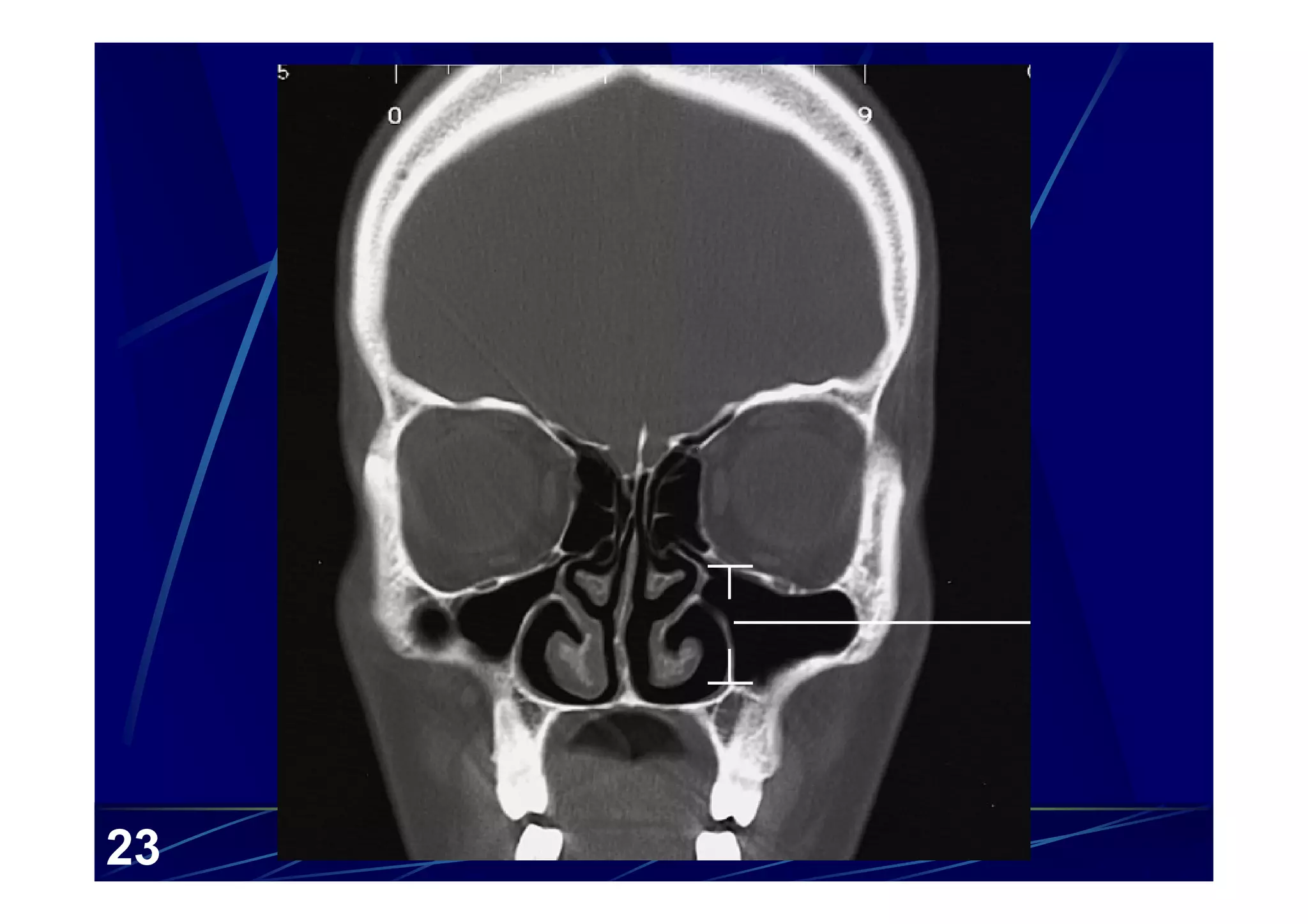 CT anatomy of the paranasal sinuses | PDF