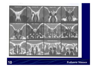 CT anatomy of the paranasal sinuses | PDF