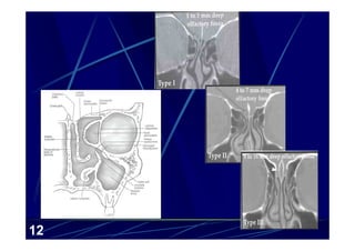 CT anatomy of the paranasal sinuses | PDF