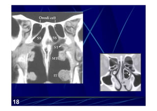 CT anatomy of the paranasal sinuses | PDF