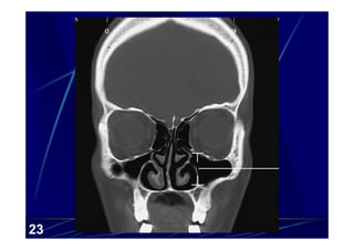 CT anatomy of the paranasal sinuses | PDF