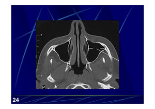CT anatomy of the paranasal sinuses | PDF